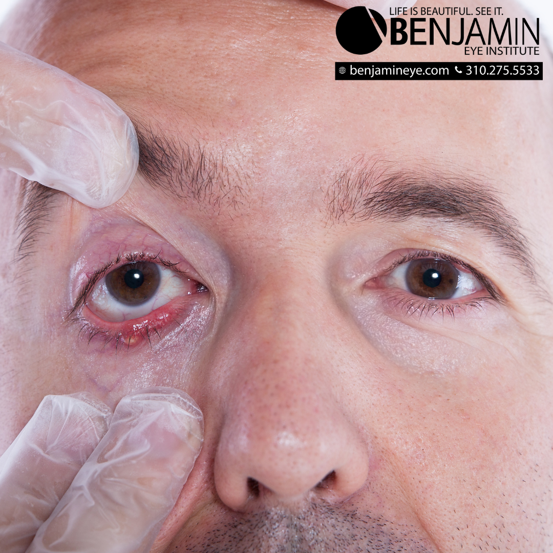 The Truth About Stye Removal: Why Professional Treatment is Crucial ...