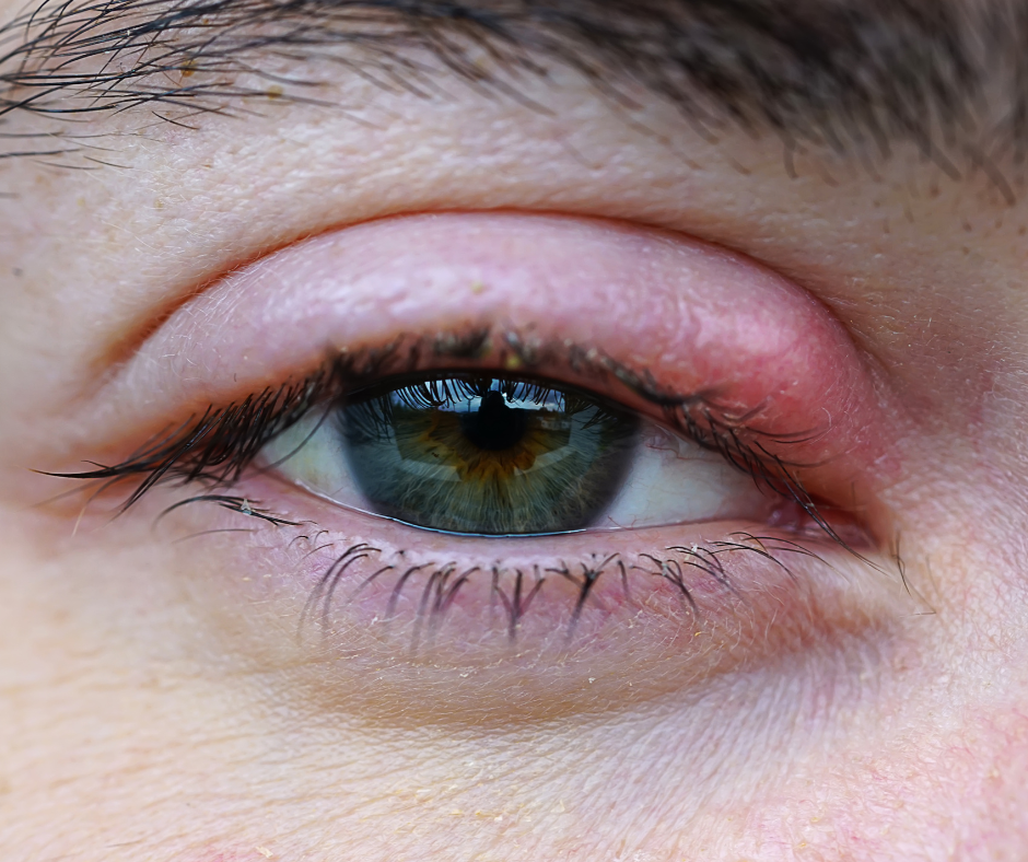 Understanding Styes: Causes, Symptoms, and Treatment Options at ...